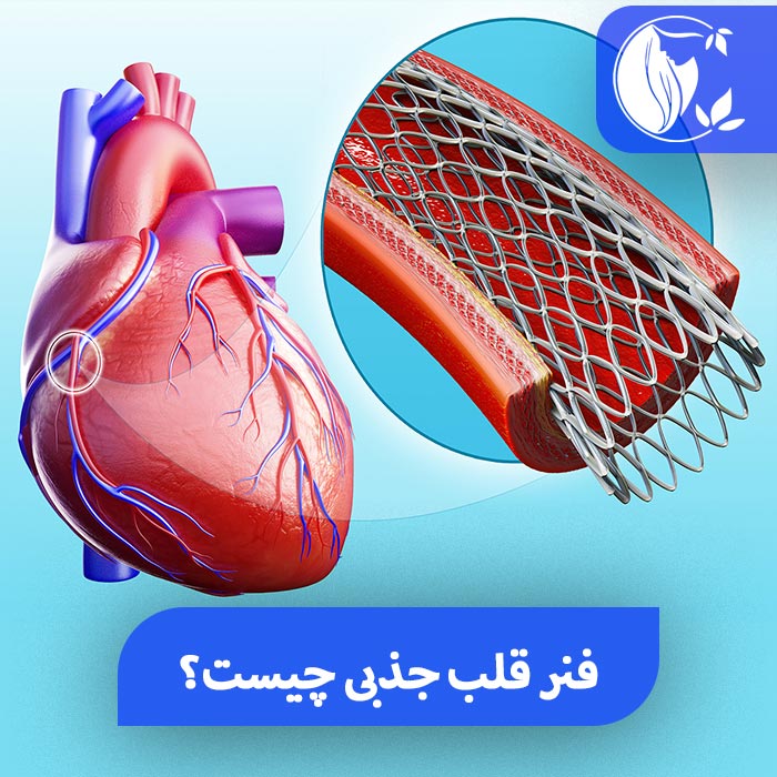 فنر قلب جذبی یا استنت چگونه گرفتگی عروق را درمان می کند؟ کلینیک قلب